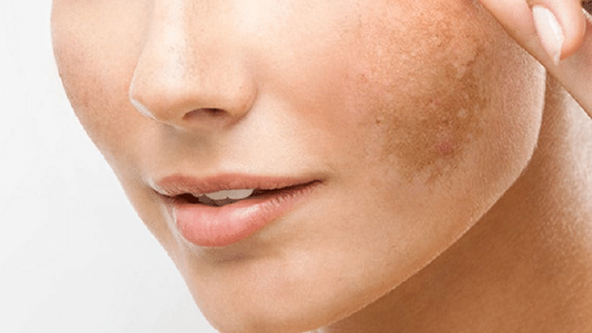 Tratamiento para las manchas de la cara - Own Skin